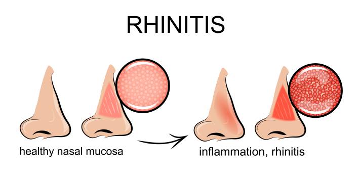 Rhinitis | Taste For Life