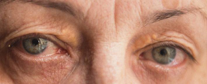 Sicca Syndrome | Taste For Life